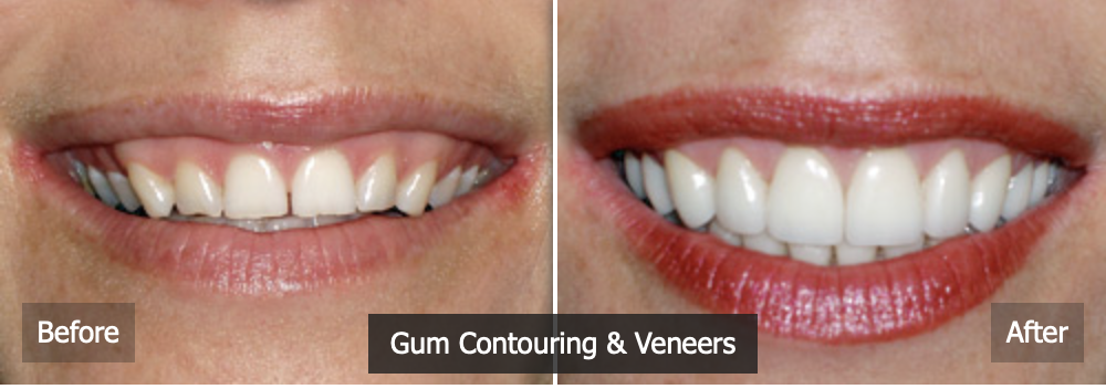 All You Need to Know About Gum Contouring - Dr. Steve Marsh DDS