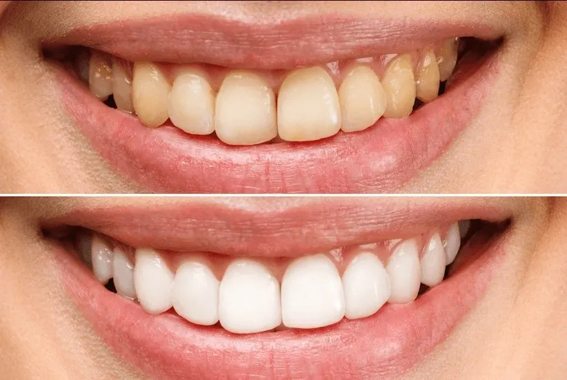 Enhance Your Smile with Teeth Whitening at ClevelandSmiles - Dr. Steve ...